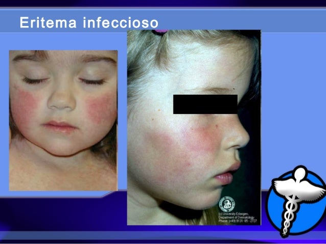 Eritema infeccioso