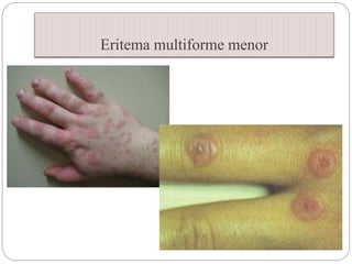 Eritema multiforme | PPTX