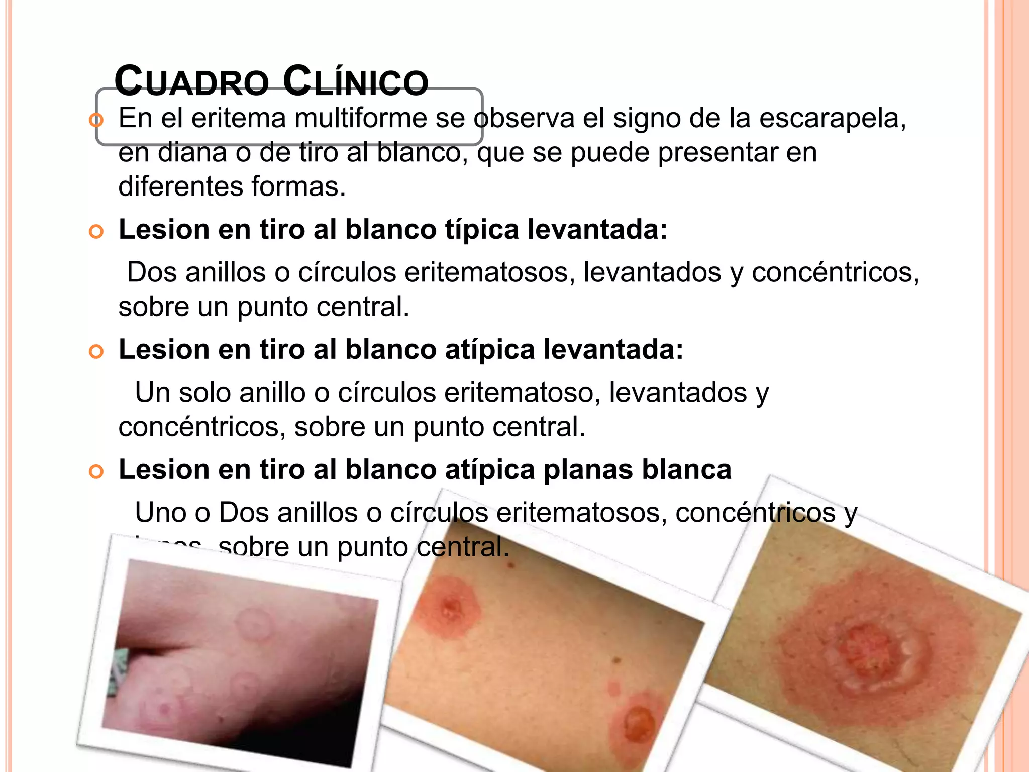 ERITEMA MULTIFORME.pptx | Skin and Dermatology | Diseases and Conditions