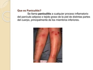 Eritema nodoso | PPTX