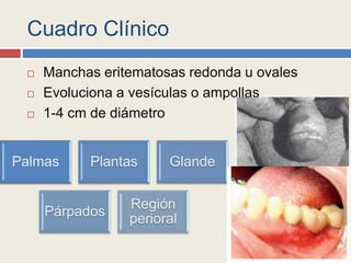 Eritema pigmentado fijo y eritema morbiliforme | PPTX