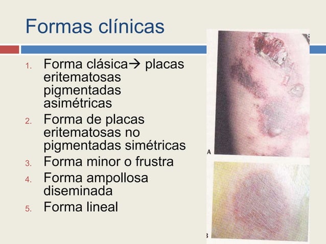 Eritema pigmentado fijo y eritema morbiliforme | PPTX
