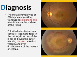 Epiretinal membrane and vitreomacula traction in updates by Panit ...