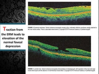 Epiretinal membrane and vitreomacula traction in updates by Panit ...
