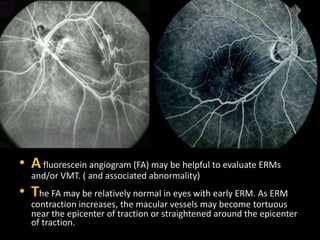 Epiretinal membrane and vitreomacula traction in updates by Panit ...