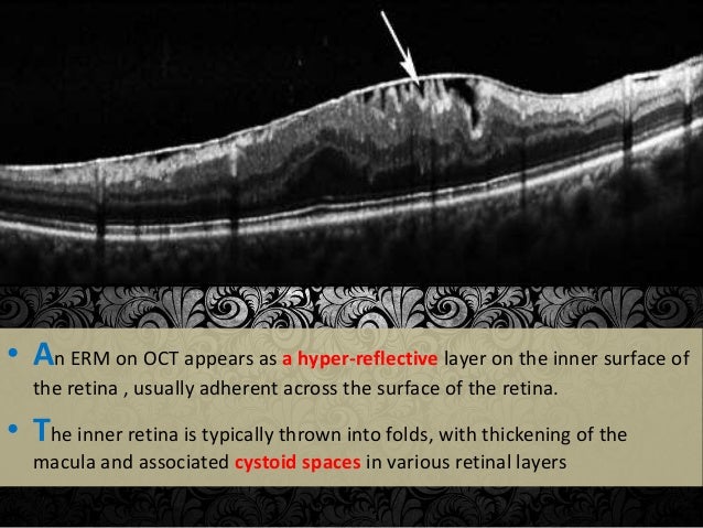 Epiretinal membrane and vitreomacula traction in updates by Panit Che…