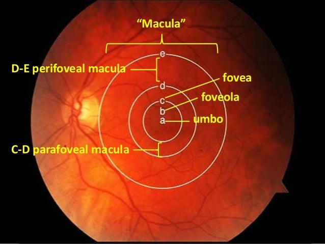 Epiretinal membrane and vitreomacula traction in updates by Panit Che…