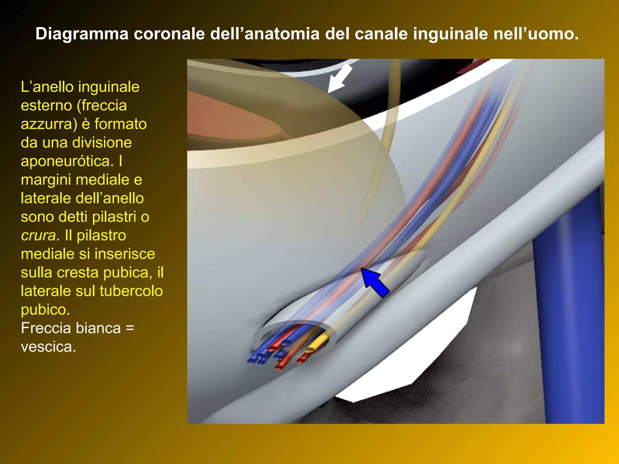 Cos'è un'ernia inguinale? Storia ed attualità della terapia chirurgica ...