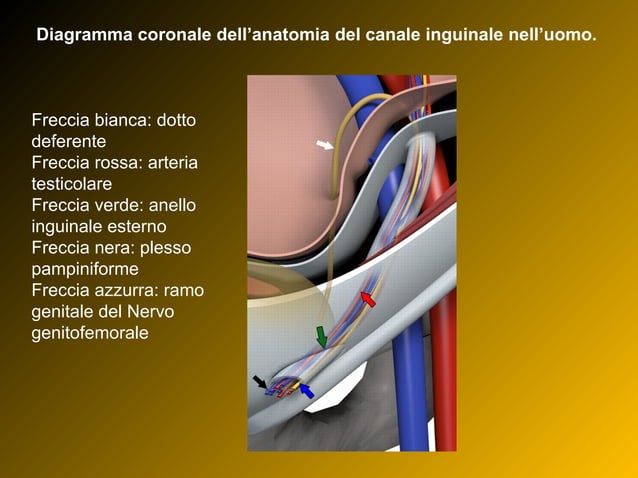 Cos'è un'ernia inguinale? Storia ed attualità della terapia chirurgica ...