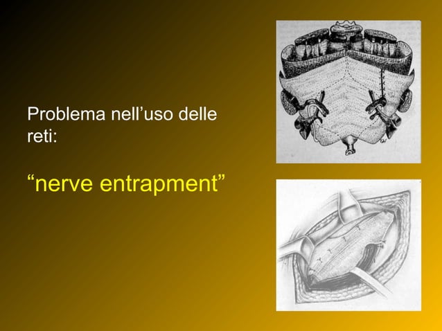 Cos'è un'ernia inguinale? Storia ed attualità della terapia chirurgica ...