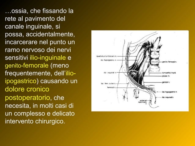 Cos'è un'ernia inguinale? Storia ed attualità della terapia chirurgica ...