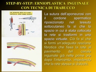 Cos'è un'ernia inguinale? Storia ed attualità della terapia chirurgica ...