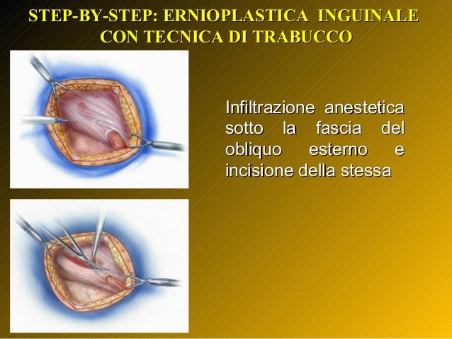 Cos'è un'ernia inguinale? Storia ed attualità della terapia chirurgica