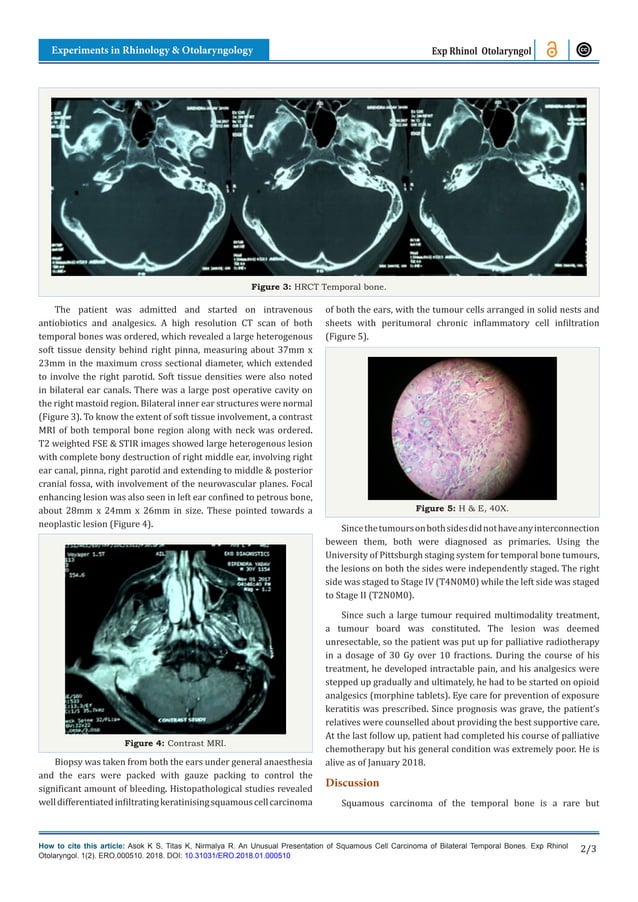 Crimson Publishers-An Unusual Presentation of Squamous Cell Carcinoma ...