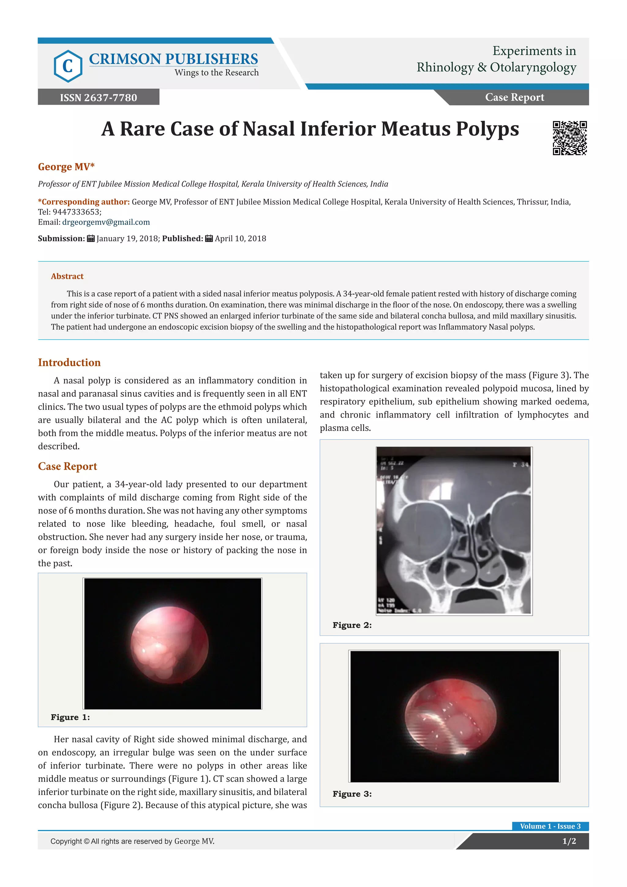 Crimson publishers-A Rare Case of Nasal Inferior Meatus Polyps | PDF