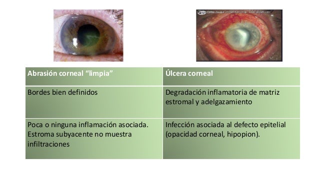 Erosión/abrasión corneal
