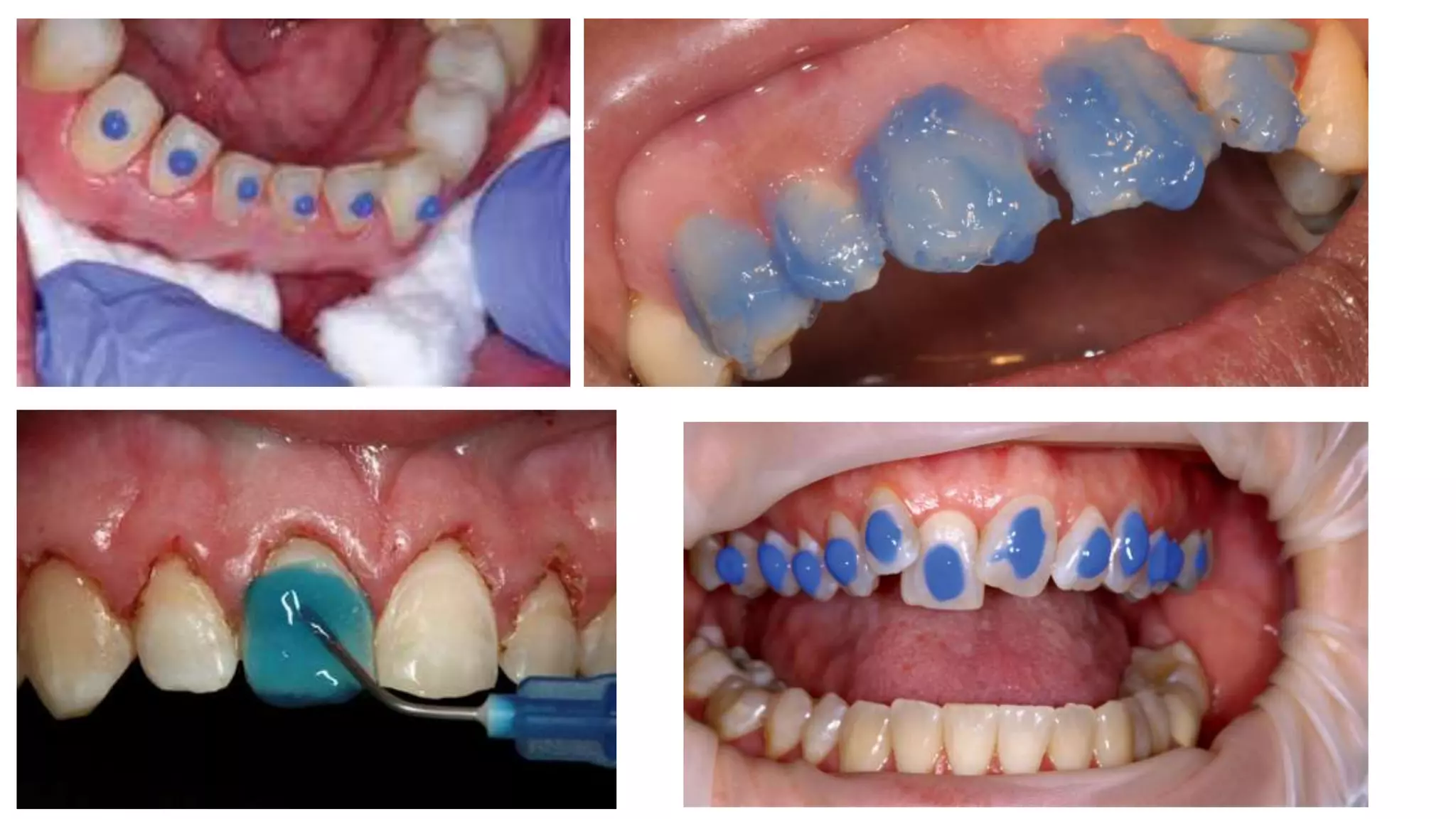 Error in orthodontic bracket placement | PPTX