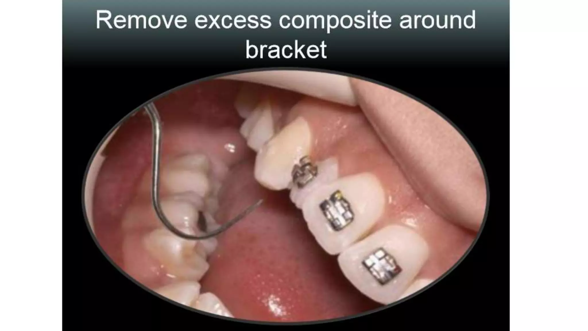 Error in orthodontic bracket placement | PPTX