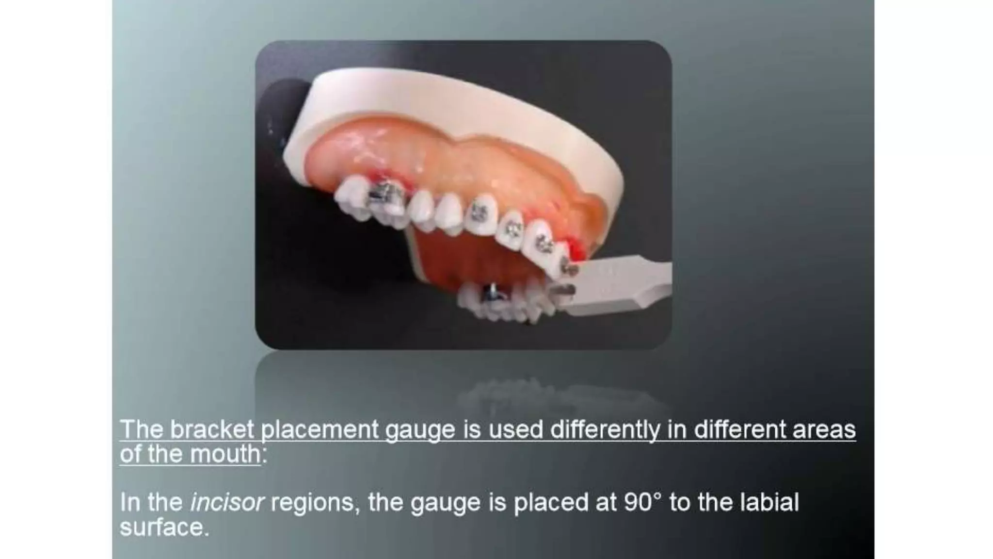Error in orthodontic bracket placement | PPTX