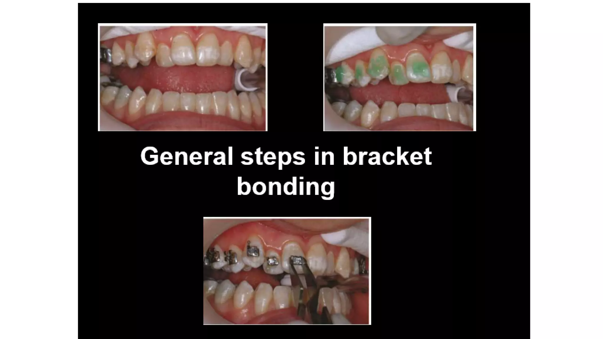 Error in orthodontic bracket placement | PPTX