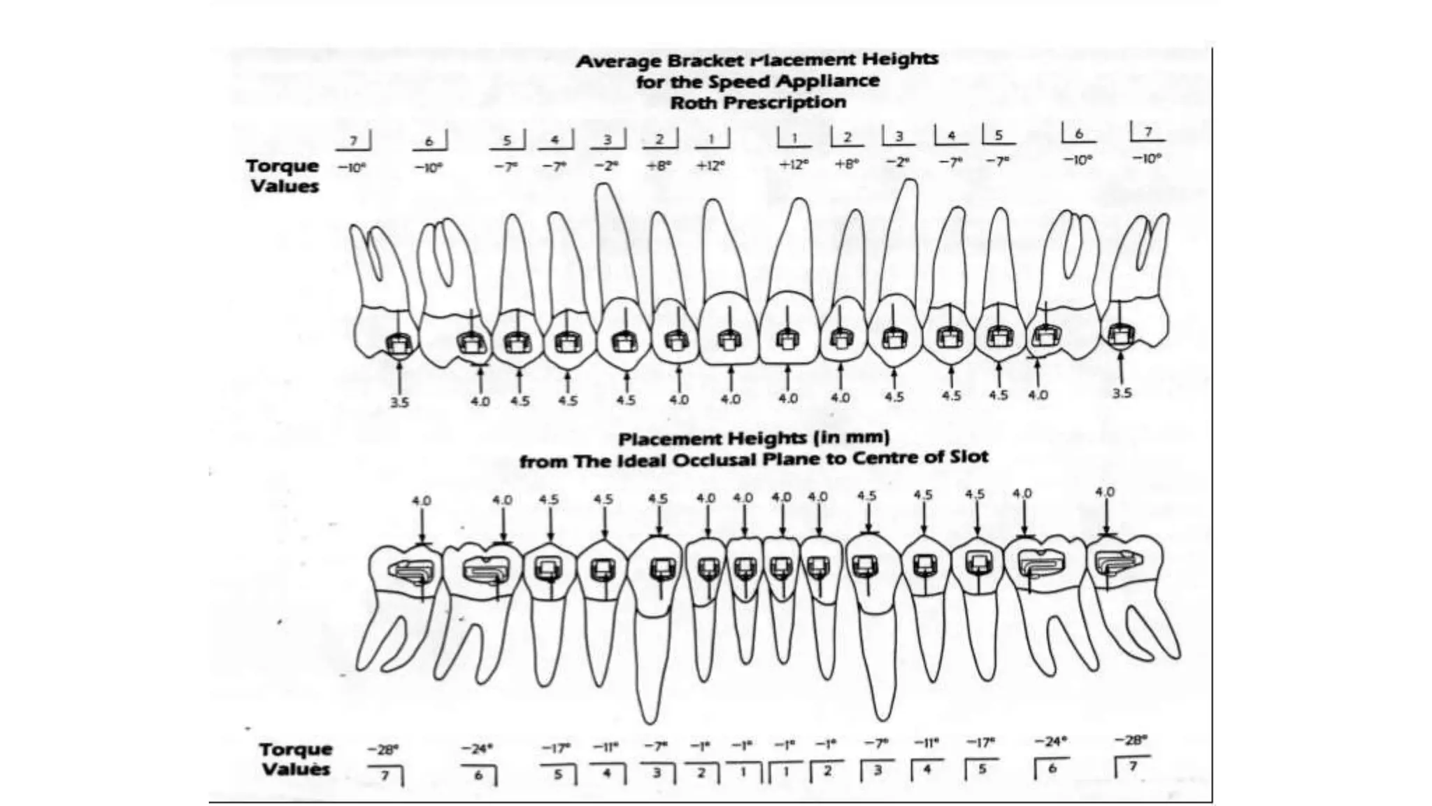 Error in orthodontic bracket placement | PPTX