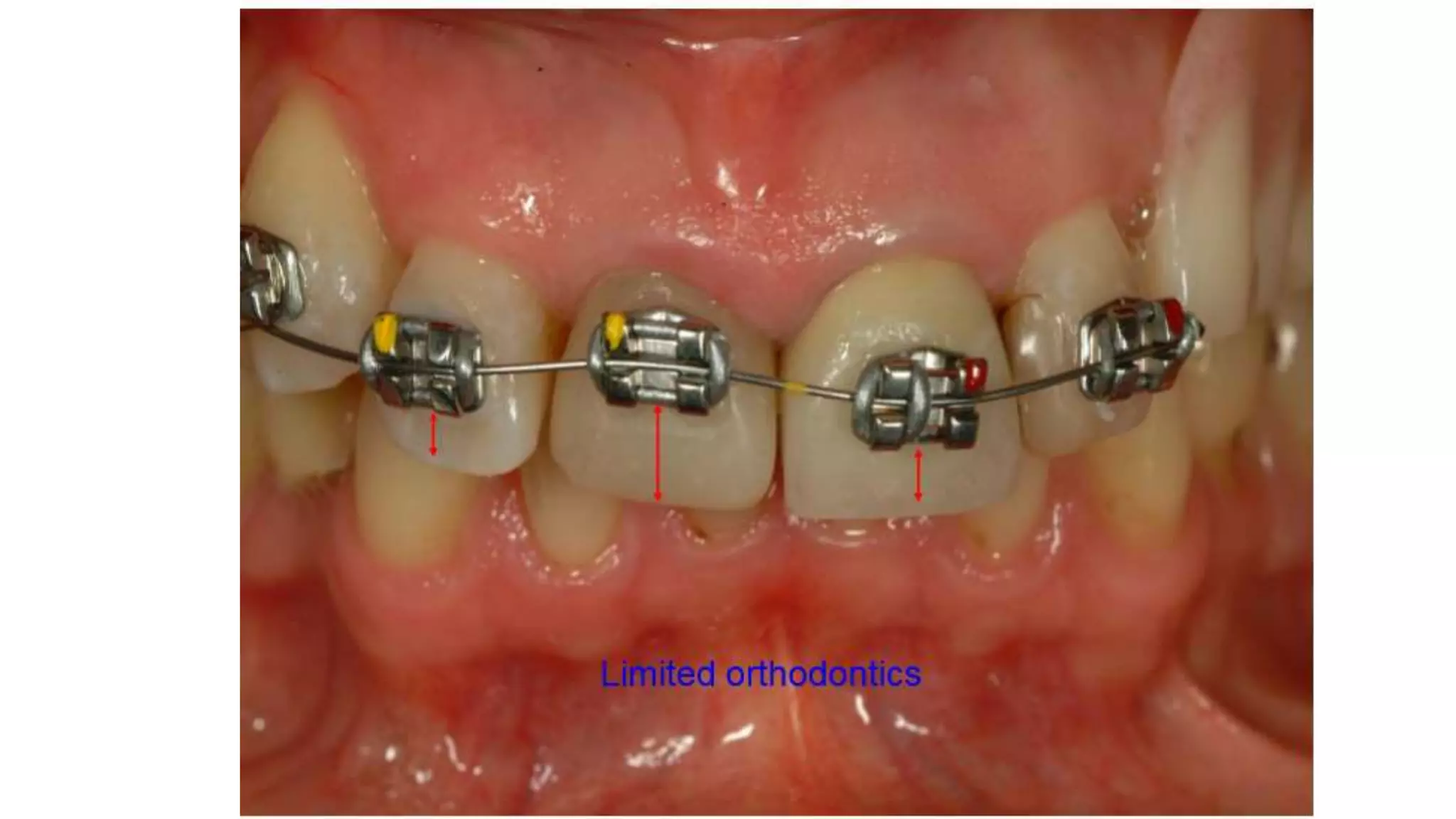 Error in orthodontic bracket placement | PPTX