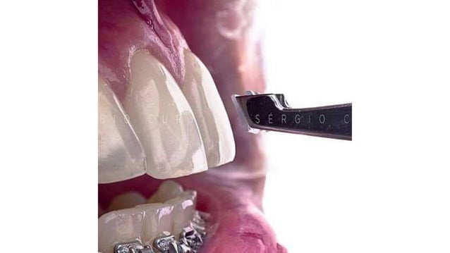 Error in orthodontic bracket placement | PPTX | Dental Health ...