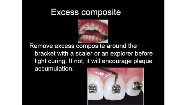 Error in orthodontic bracket placement | PPTX | Dental Health ...
