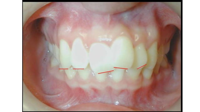 Error in orthodontic bracket placement | PPTX | Dental Health ...
