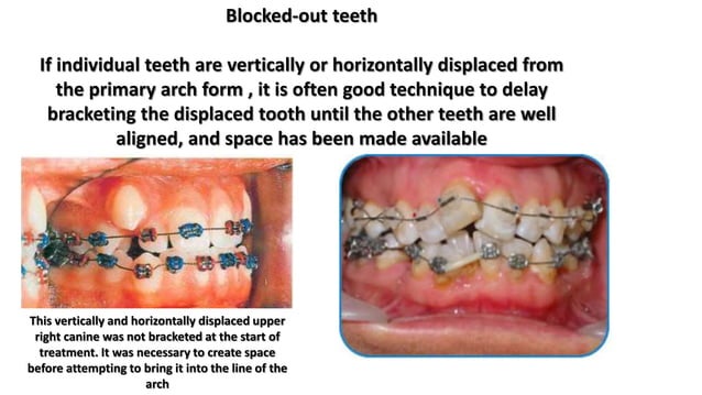 Error in orthodontic bracket placement | PPTX | Dental Health ...