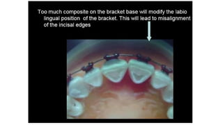 Error in orthodontic bracket placement | PPTX