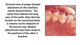 Error in orthodontic bracket placement | PPTX