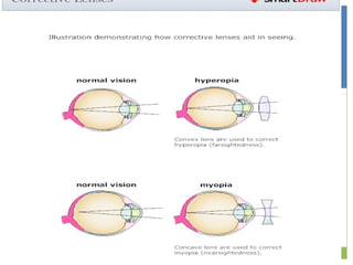 Error of Refraction | PPT