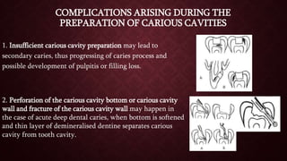 Errors and complications in the treatment of tooth decay (Dentistry) | PPTX