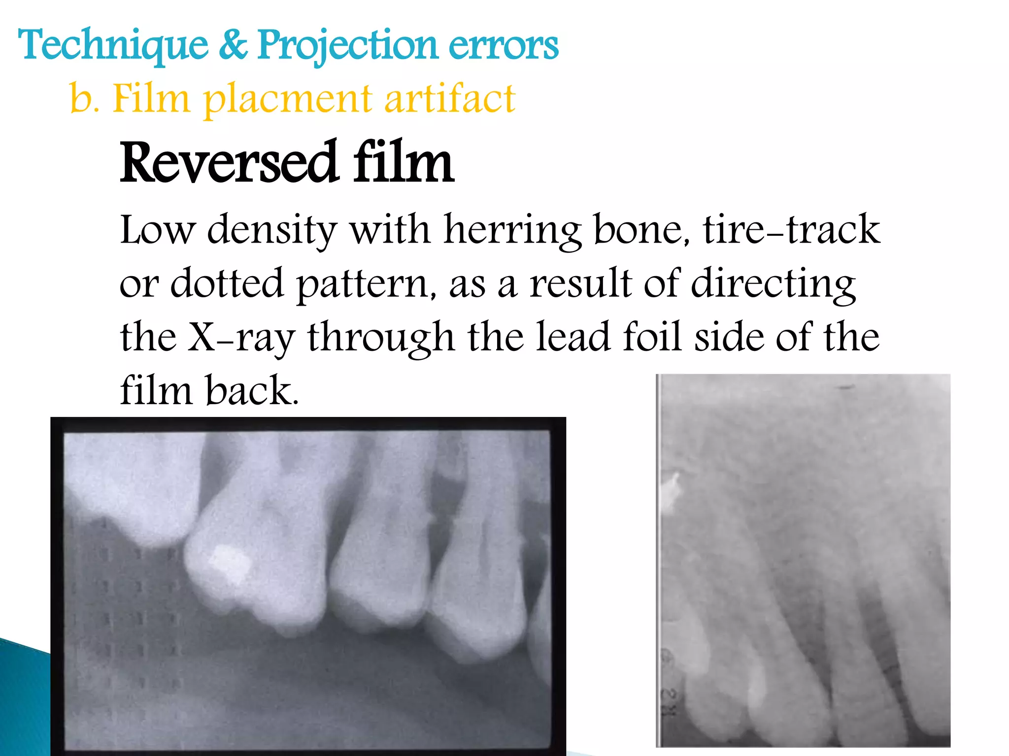 Errors of dental radiography | PPTX