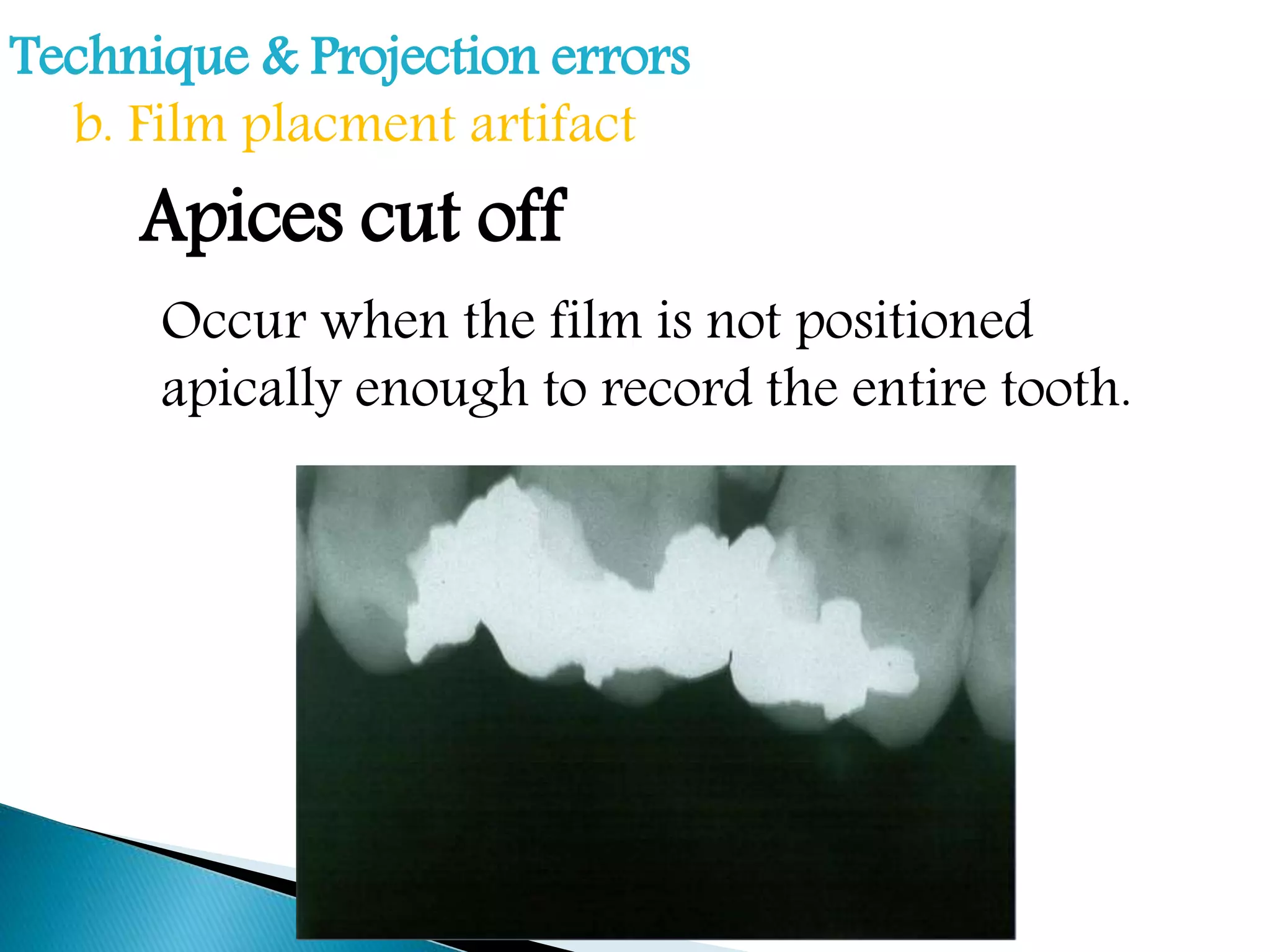 Errors of dental radiography | PPTX