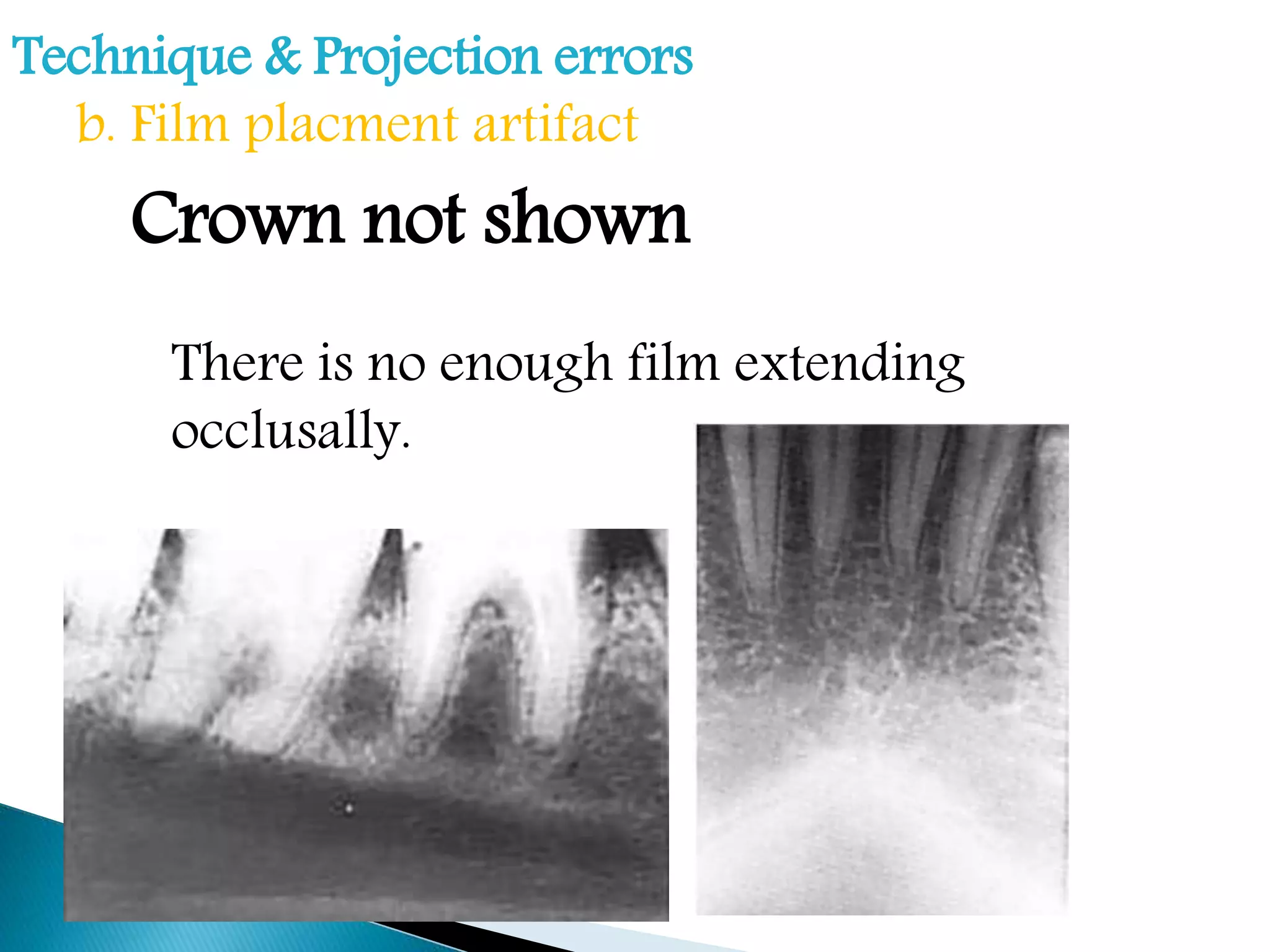 Errors of dental radiography | PPTX