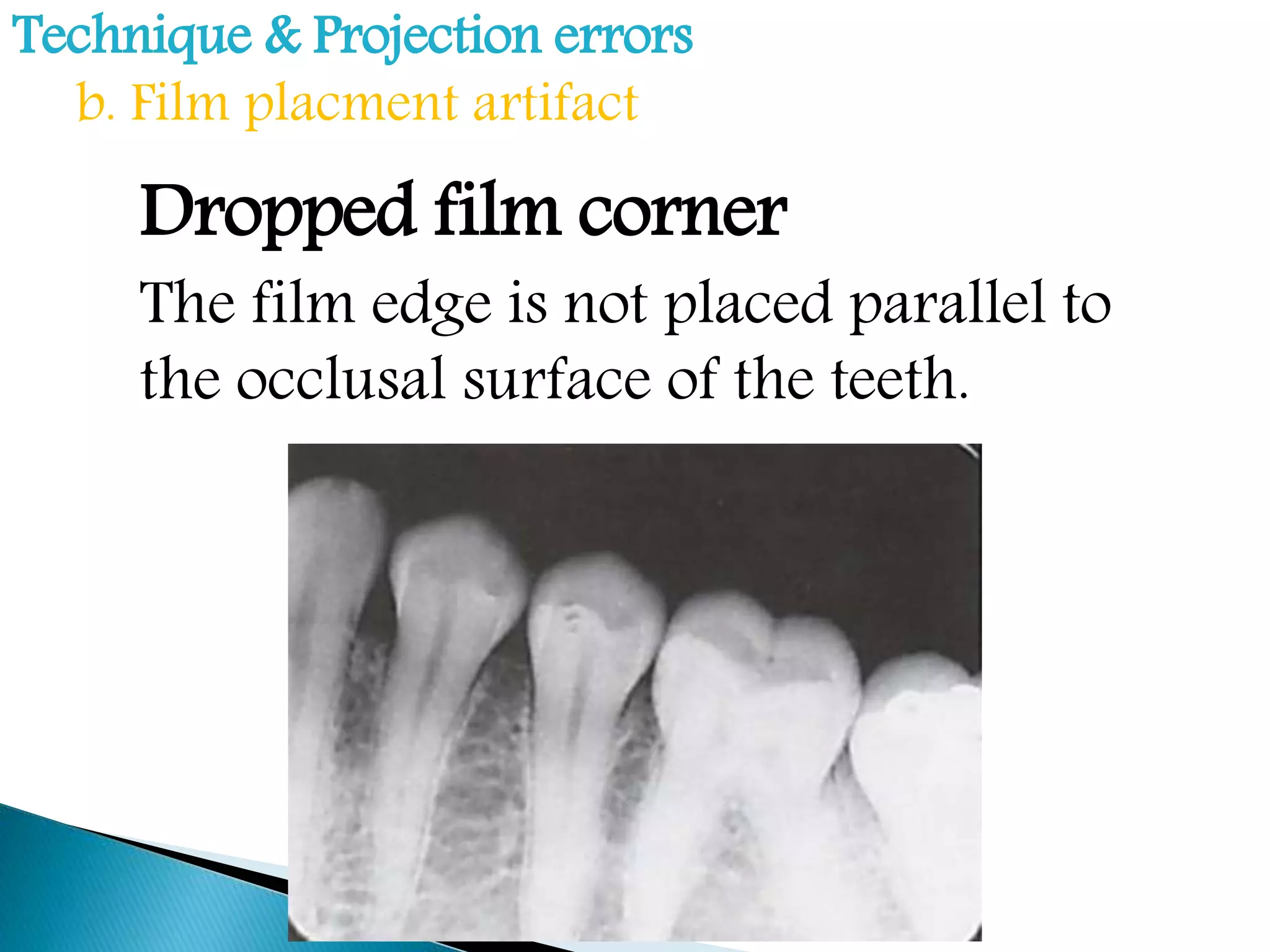 Errors of dental radiography | PPTX
