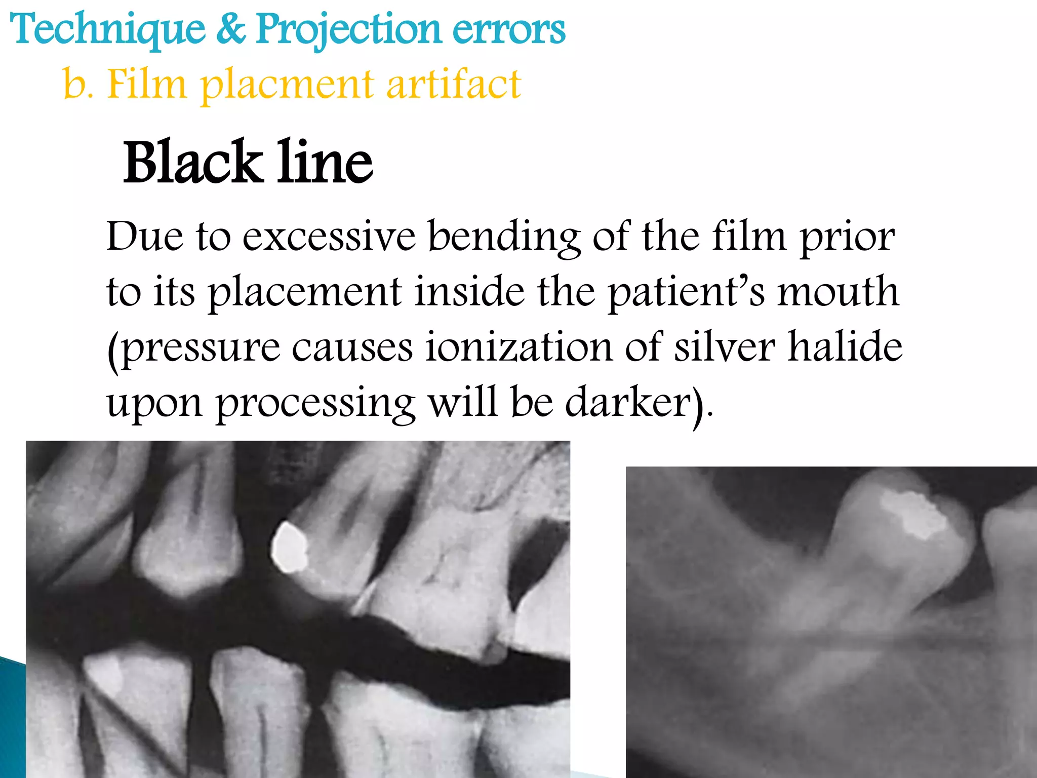 Errors of dental radiography | PPTX