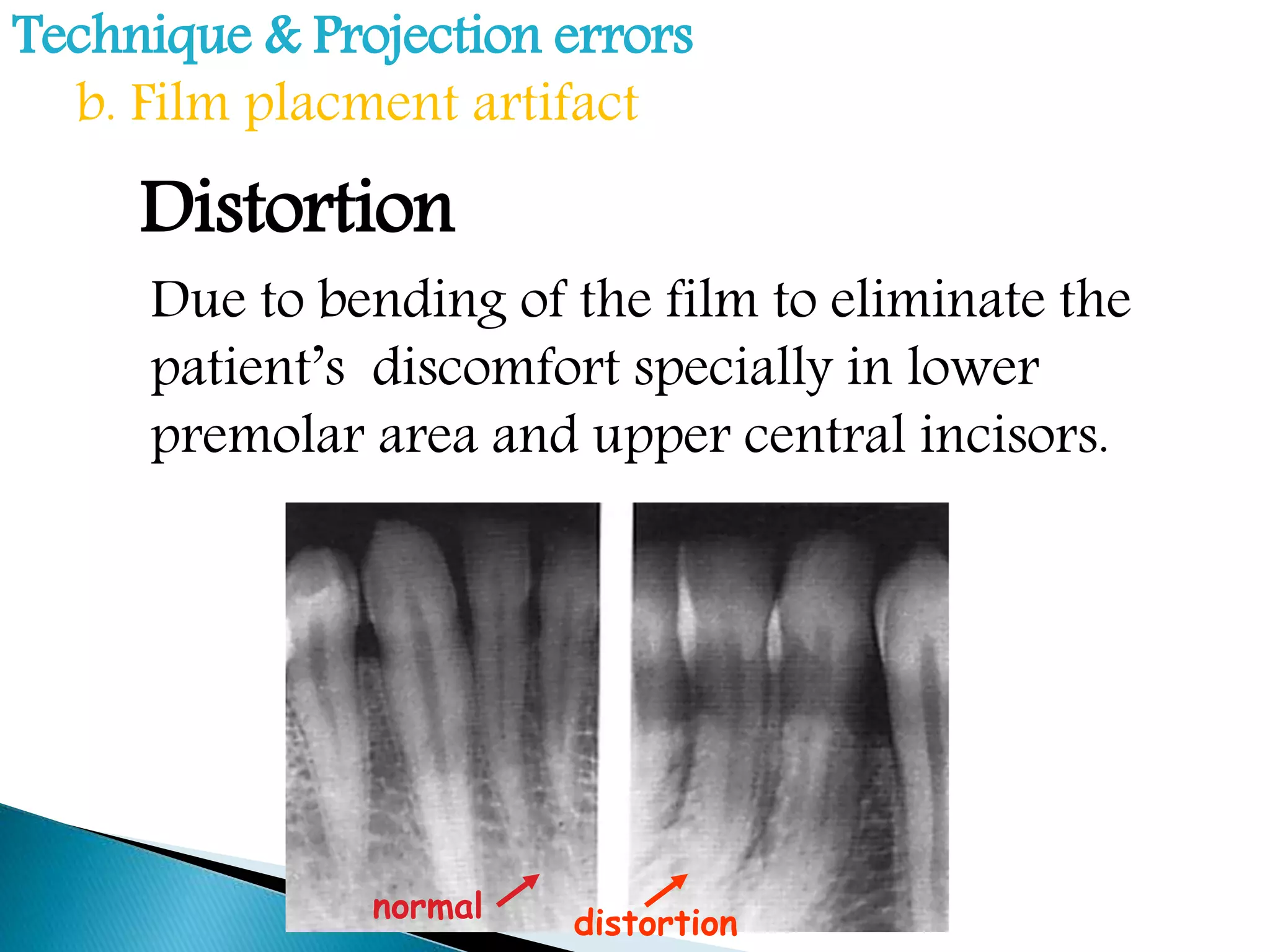 Errors of dental radiography | PPTX