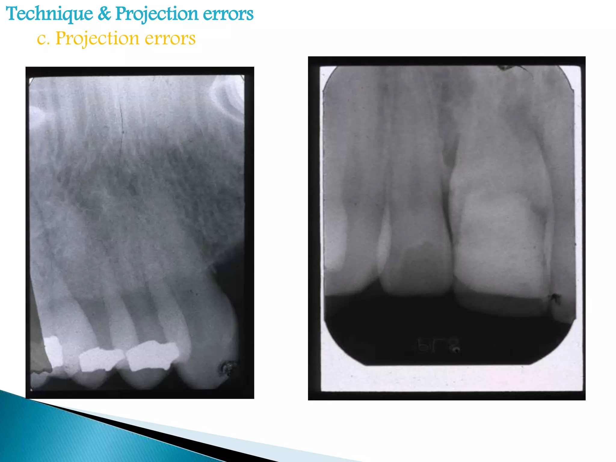 Errors of dental radiography | PPTX