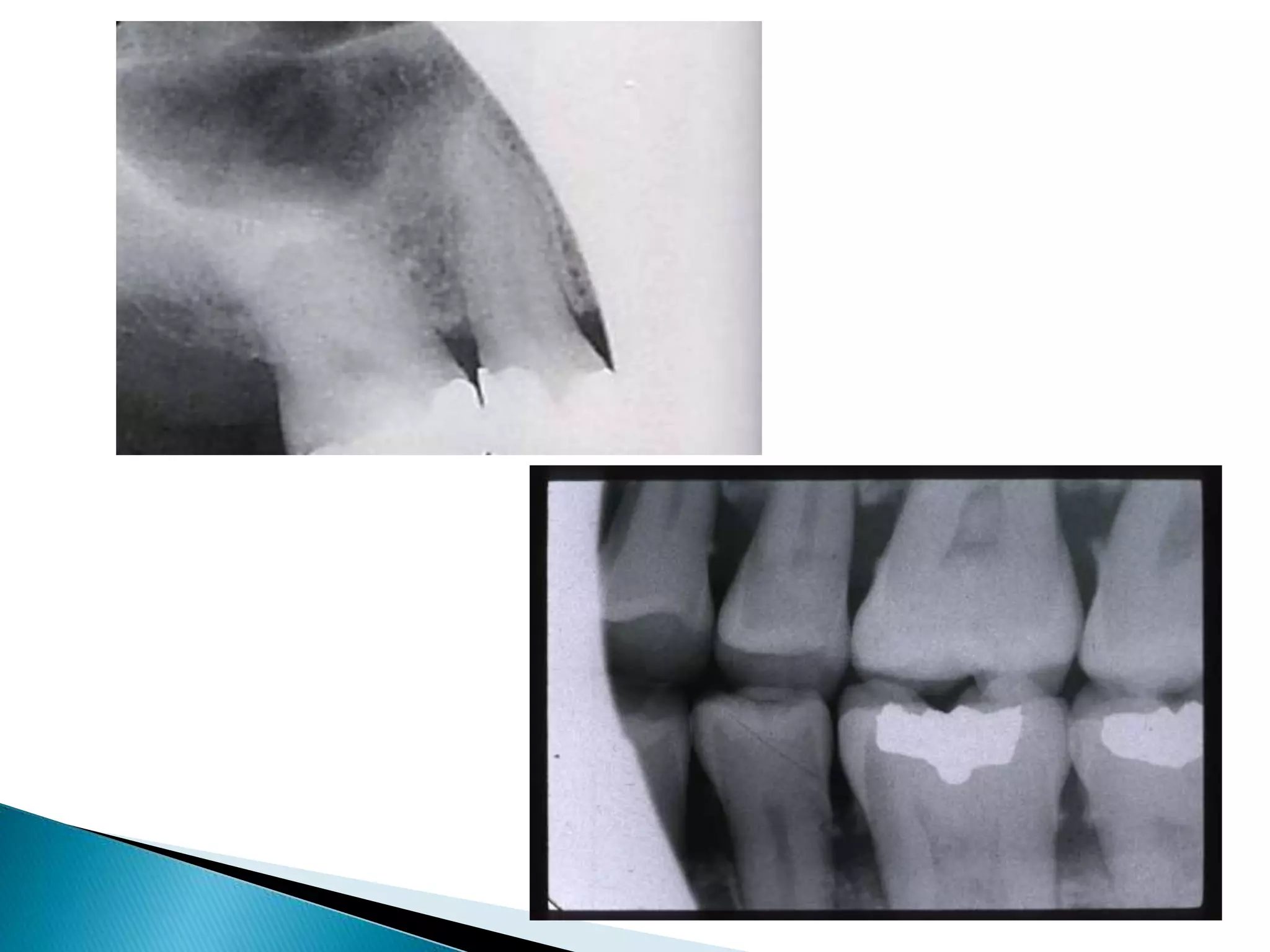 Errors of dental radiography | PPTX
