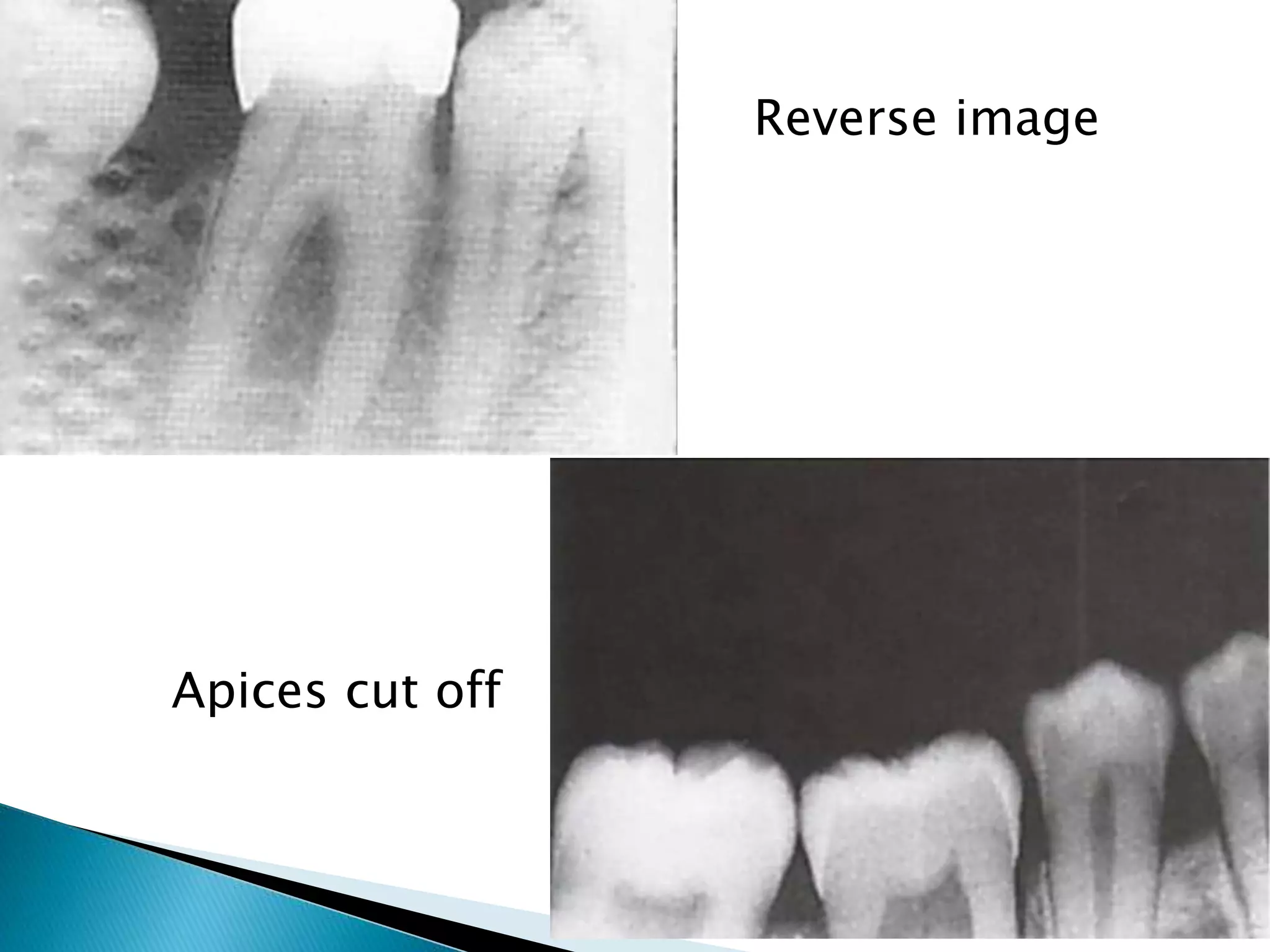 Errors of dental radiography | PPTX