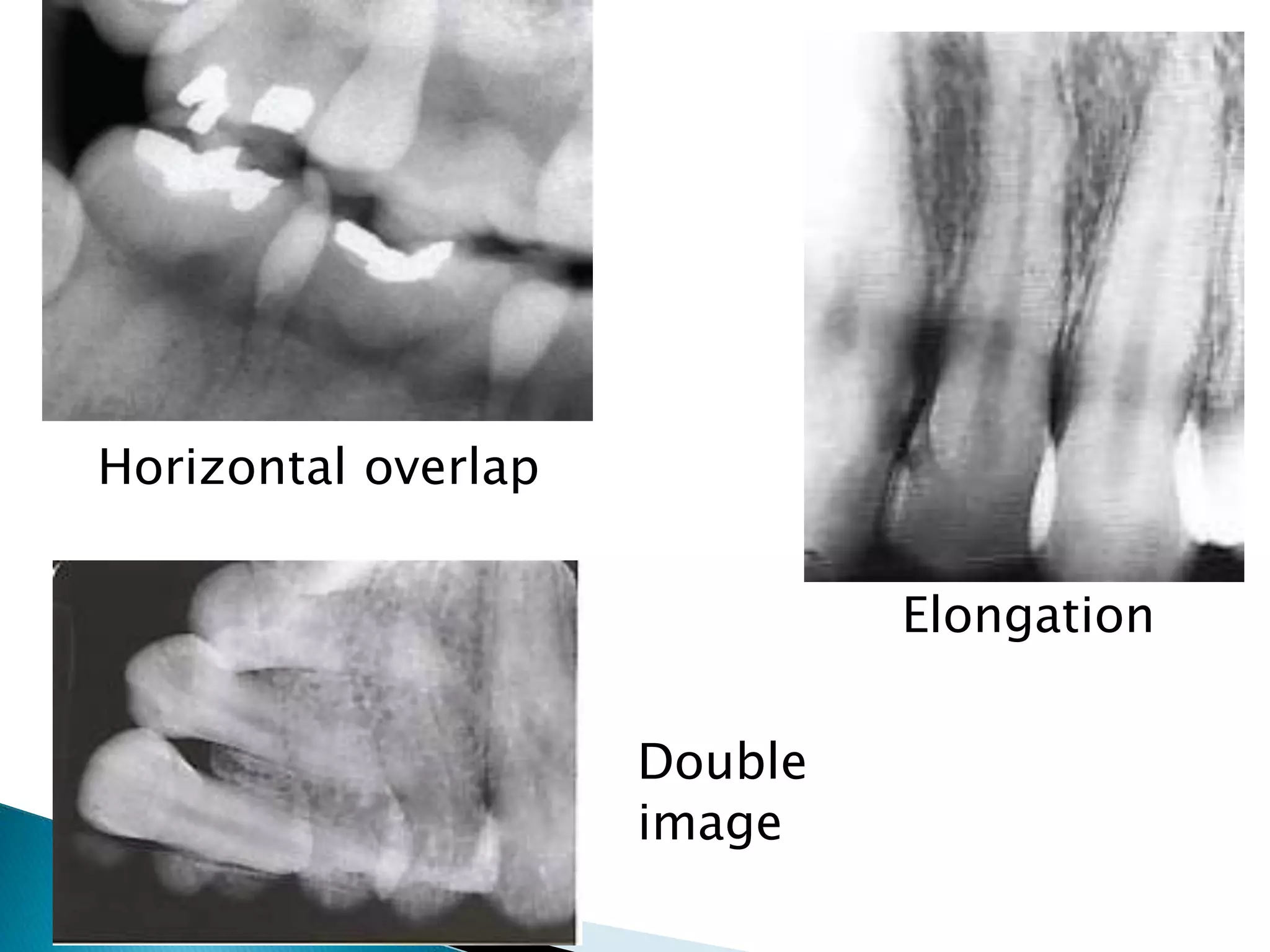 Errors of dental radiography | PPTX