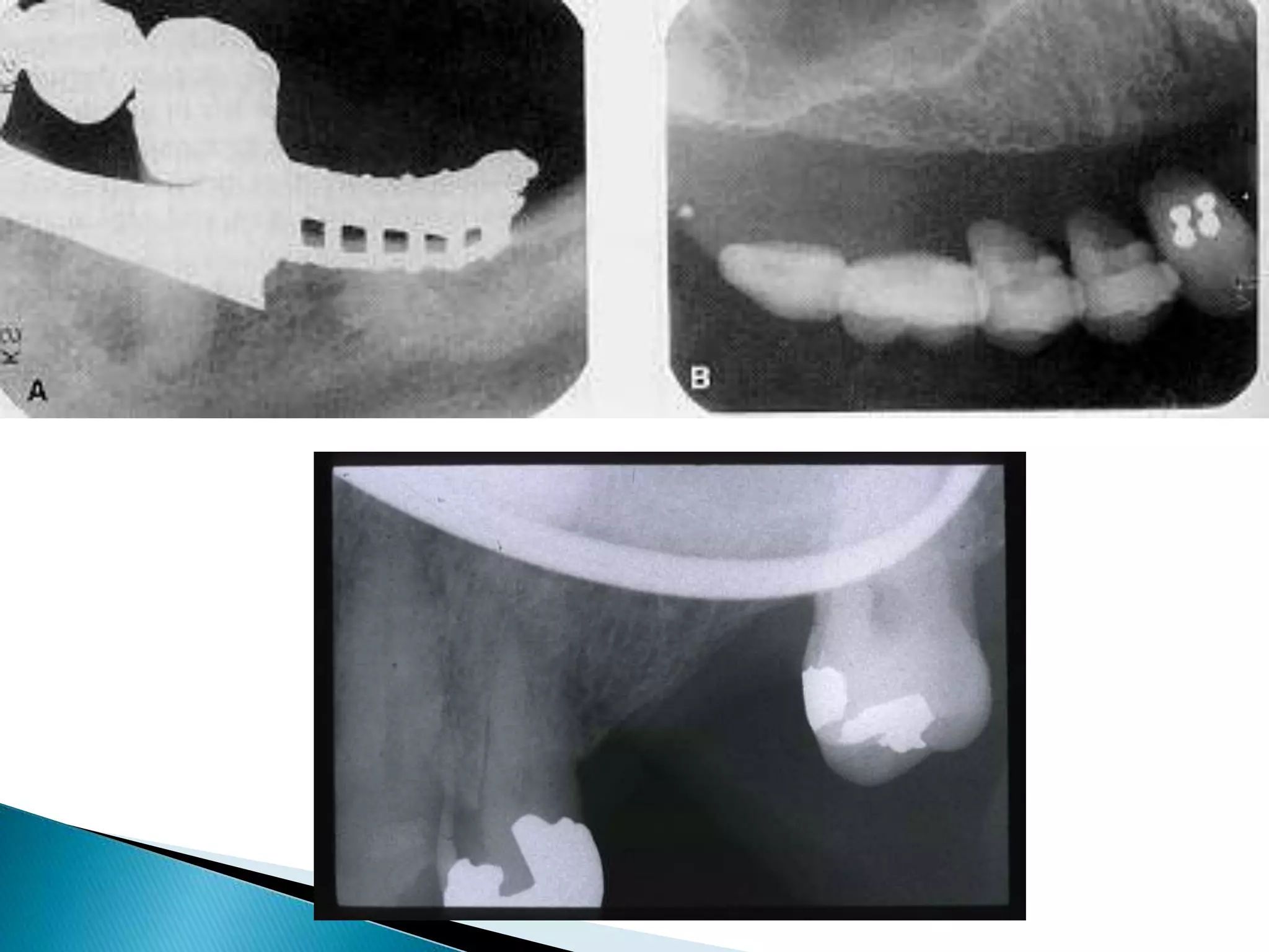 Errors of dental radiography | PPTX