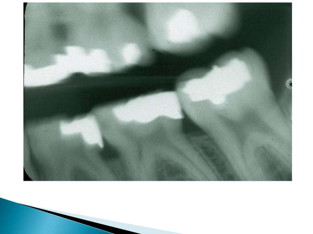 Errors of dental radiography | PPTX