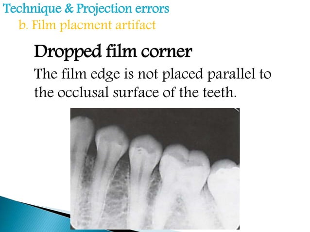 Errors of dental radiography | PPTX