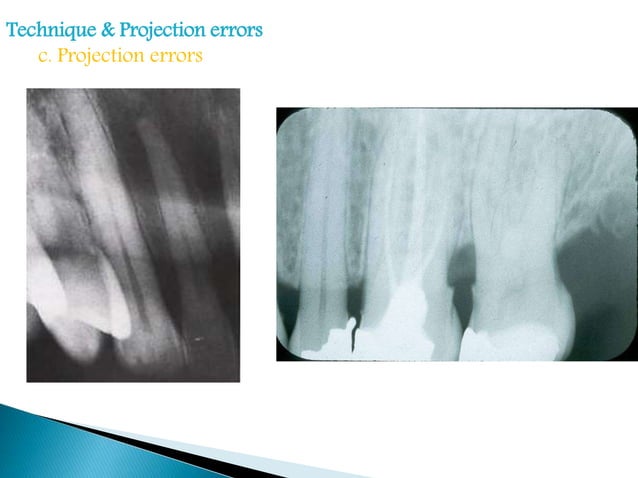 Errors of dental radiography | PPTX