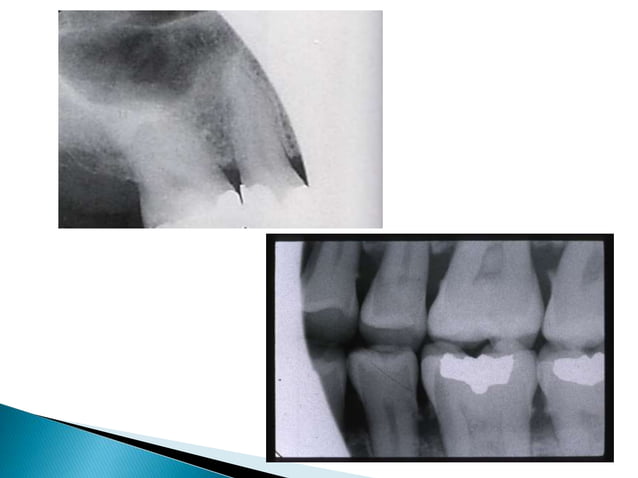 Errors of dental radiography | PPTX