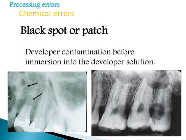 Errors of dental radiography | PPTX